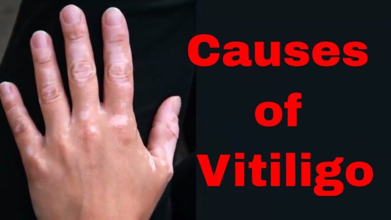 What Are The Symptoms And Causes Of Vitiligo Live Enhanced