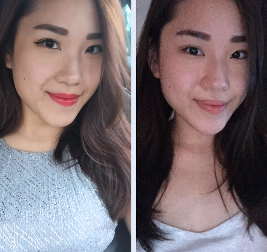 10 Q&A by Aesthetic Doctors on Nose Threads in Singapore - Live Enhanced