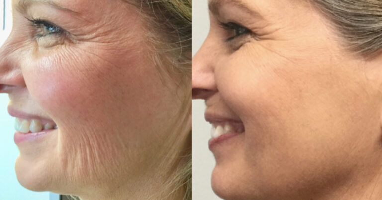 A Look At Morpheus 8 Before and After Results - Live Enhanced